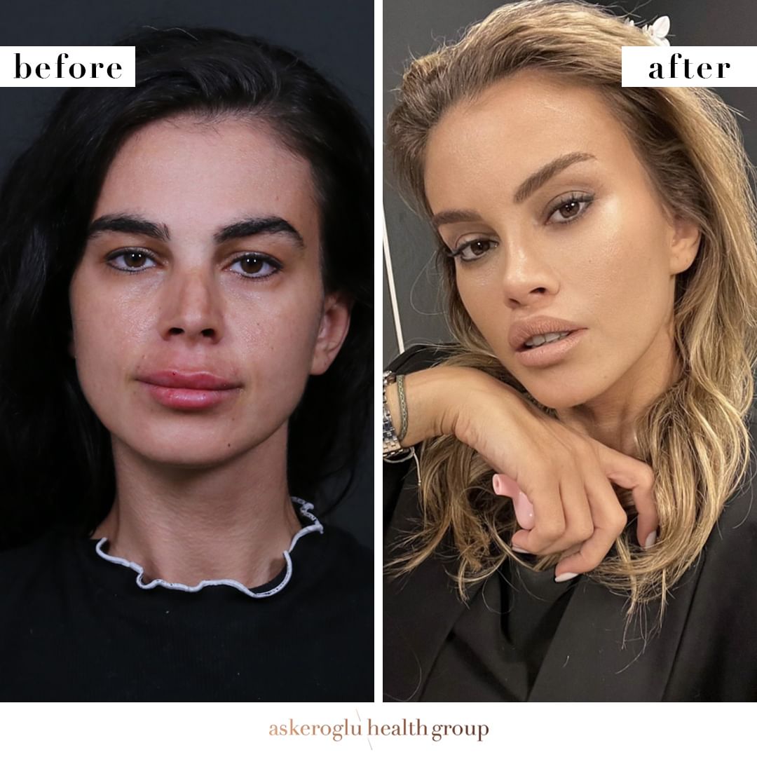 Diferencias entre ptosis y blefaroplastia - Askeroglu Health Group