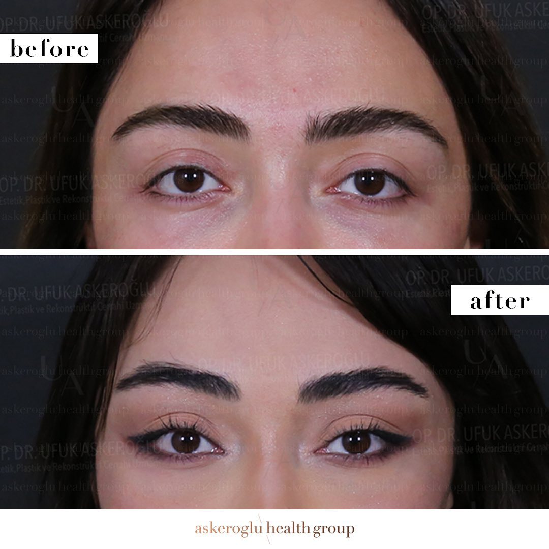 Ventajas lifting endoscópico mitad cara - Askeroglu Health Group