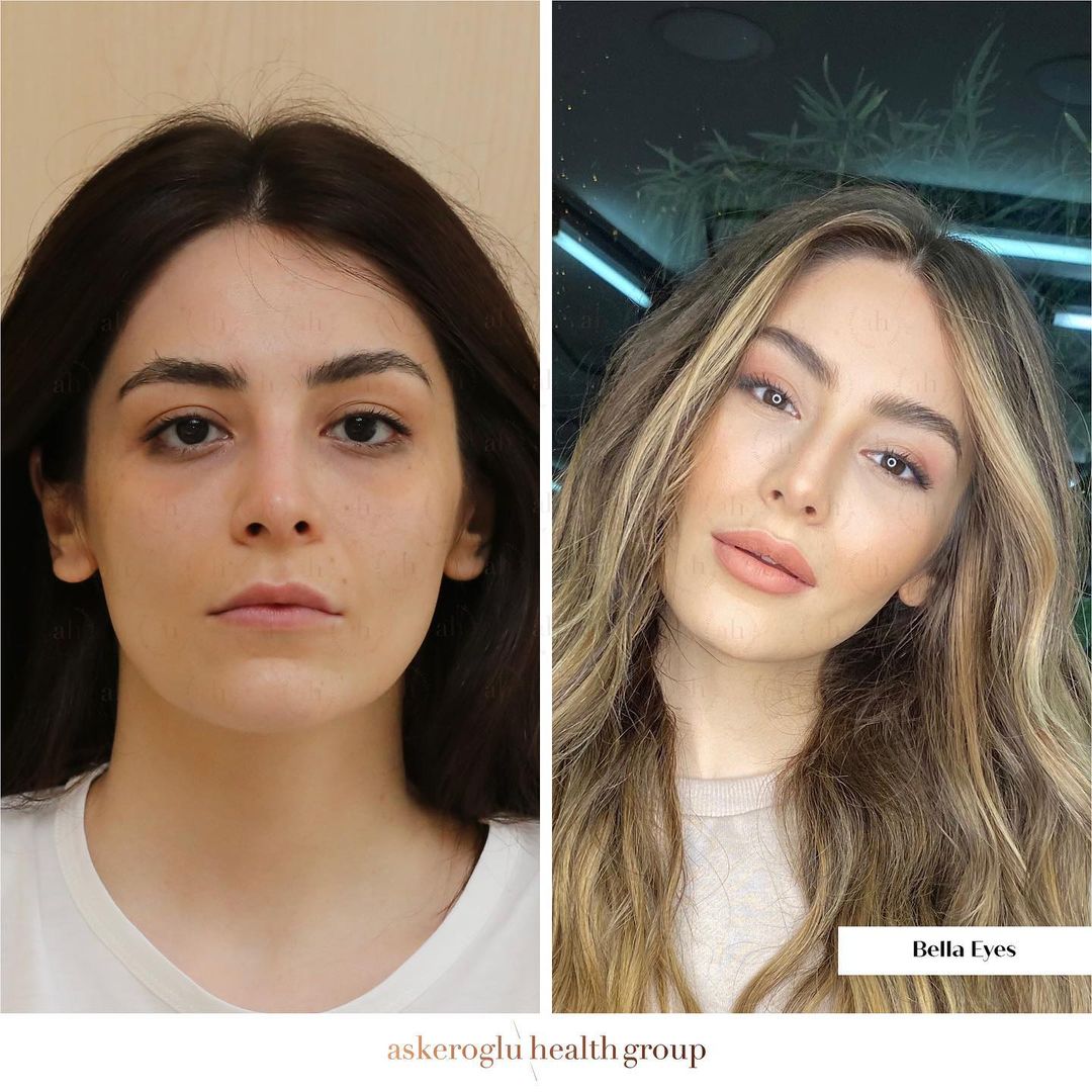 Diferencias entre ptosis y blefaroplastia - Askeroglu Health Group