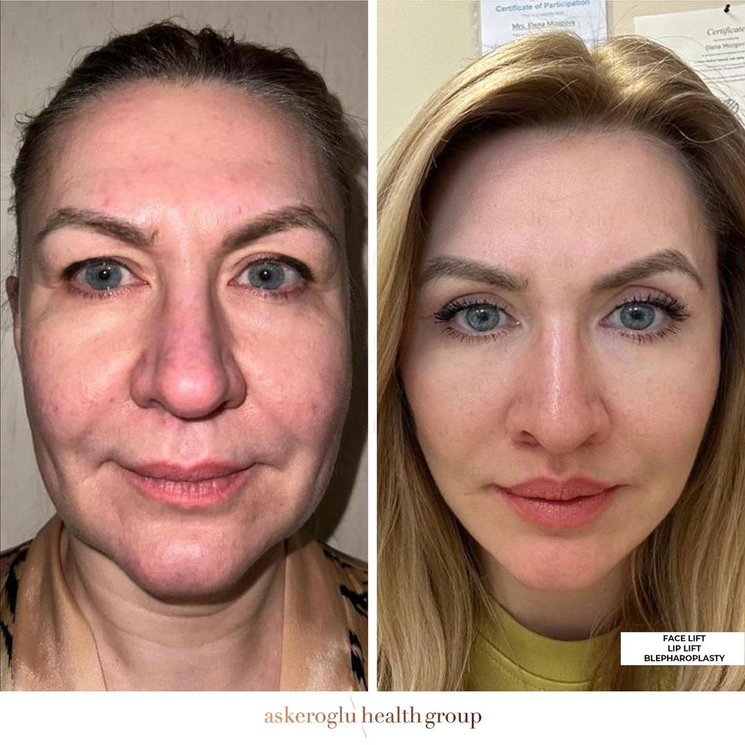 Best Facelift Surgeon Turkey - Askeroglu Health Group
