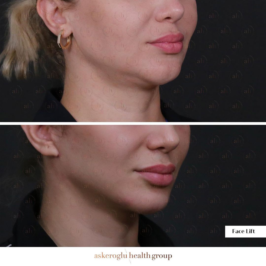 Best Facelift Surgeon Turkey - Askeroglu Health Group