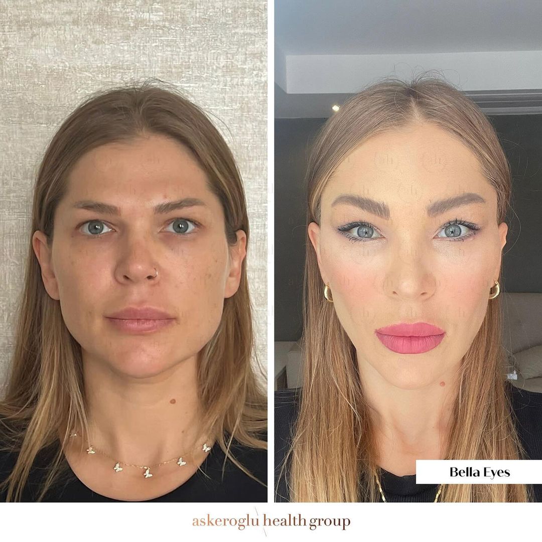 Ventajas lifting endoscópico mitad cara - Askeroglu Health Group
