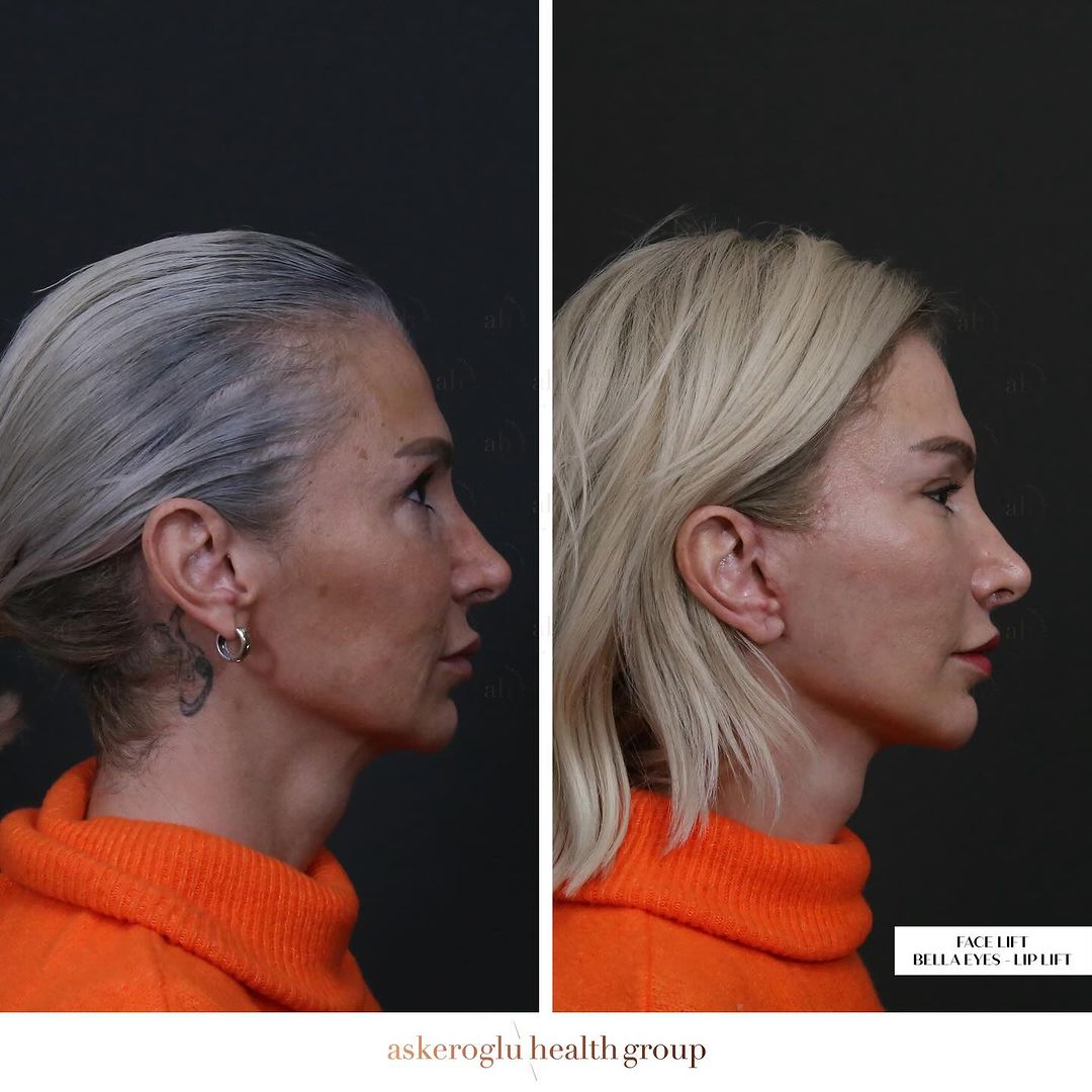 Best Facelift Surgeon Turkey - Askeroglu Health Group