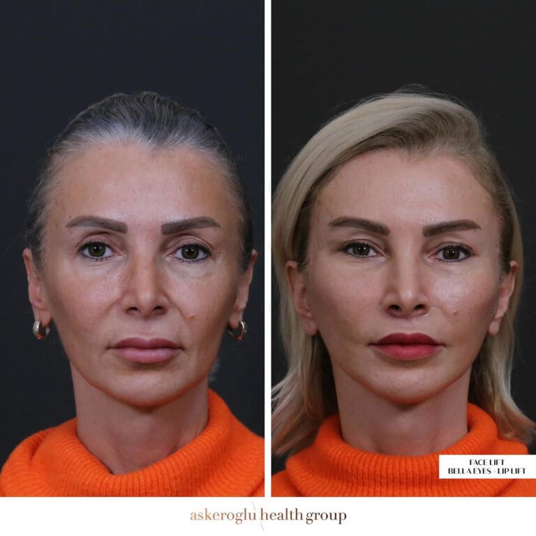 Deep Plane Facelift Turkey - Askeroglu Health Group
