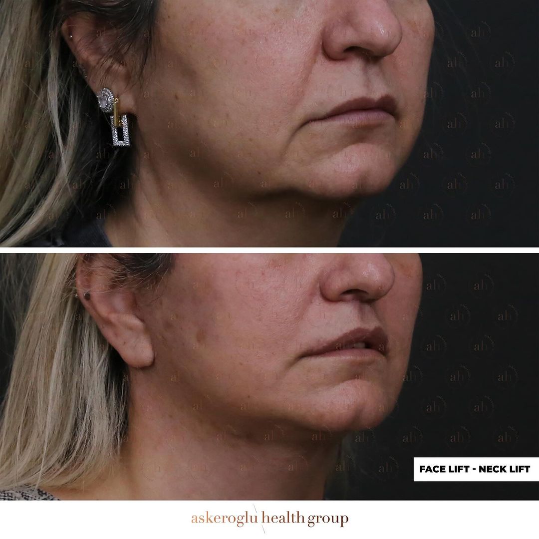 Deep Plane Facelift Turkey - Askeroglu Health Group