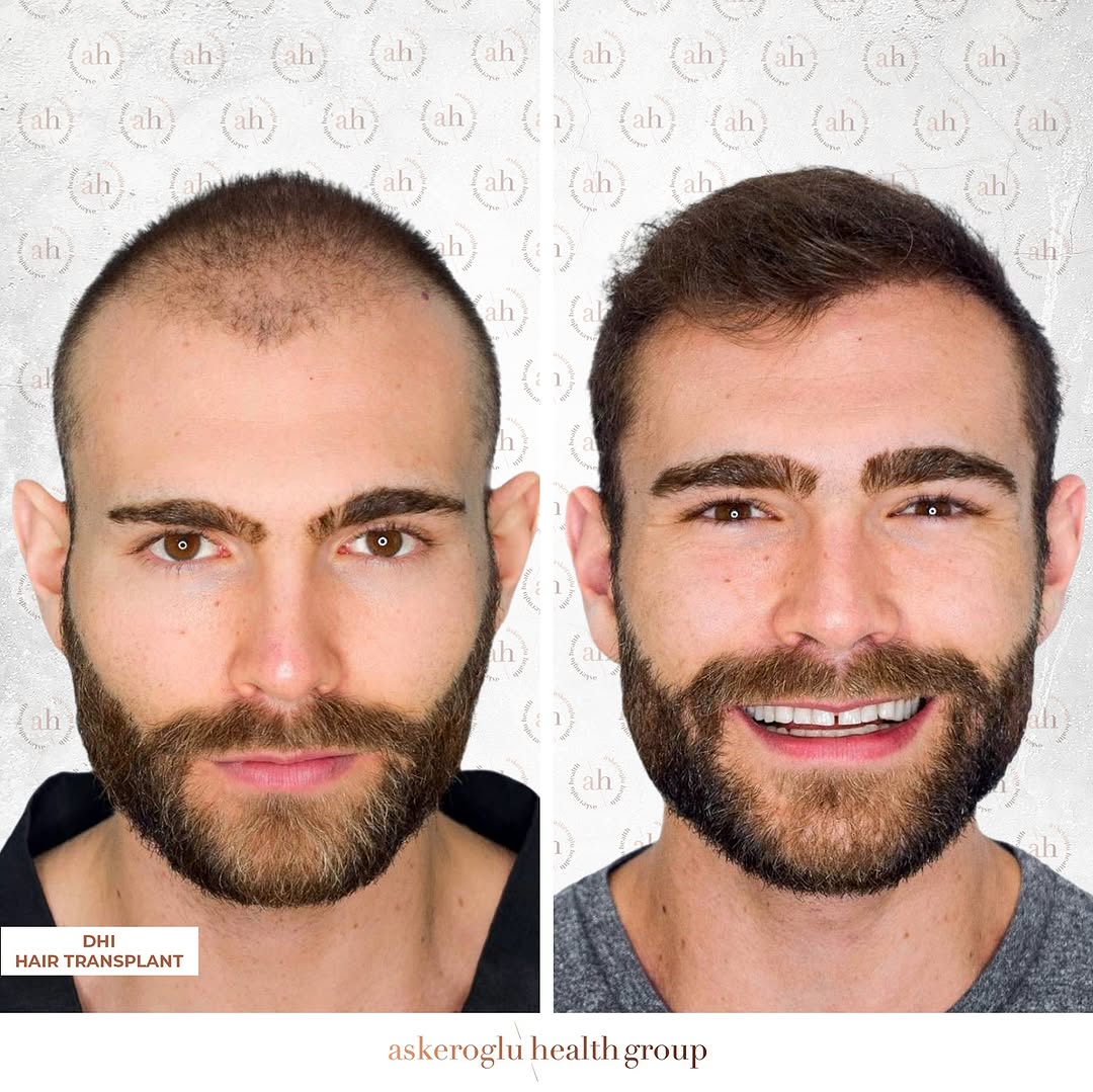 Varieties of Hair Transplant - Askeroglu Health Group