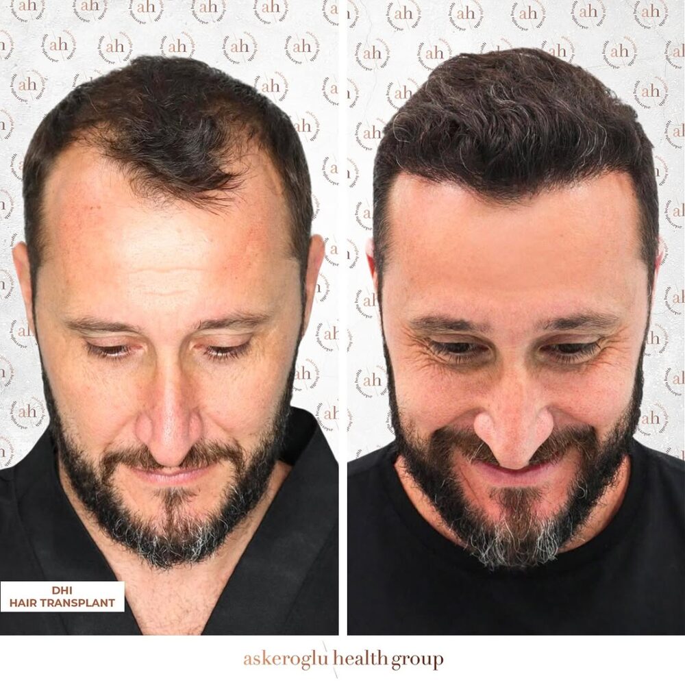 Varieties of Hair Transplant - Askeroglu Health Group