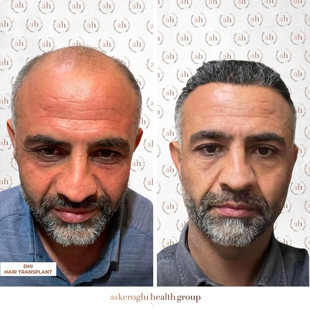 Varieties of Hair Transplant - Askeroglu Health Group