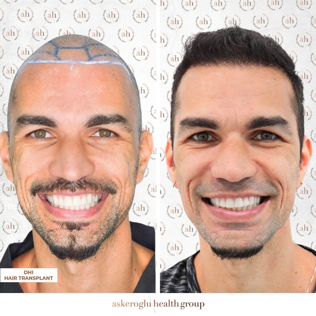 Hair Transplant Turkey - Askeroglu Health Group
